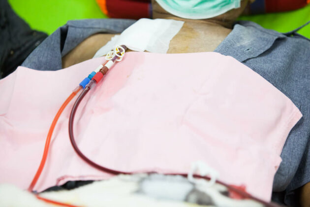 How to Care for Your Central Venous Catheter (CVC) - The Hope